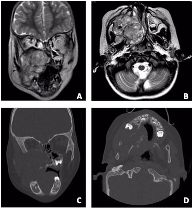 TUMOR NEUROECTODÉRMICO PRIMITIVO DEL SENO MAXILAR DERECHO: REPORTE DE ...