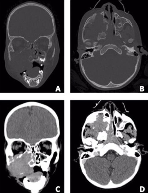 TUMOR NEUROECTODÉRMICO PRIMITIVO DEL SENO MAXILAR DERECHO: REPORTE DE ...